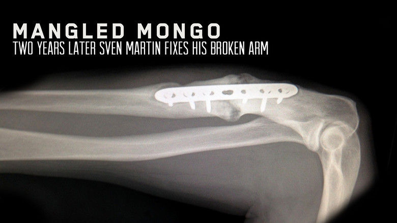 Mangled Mongo - 2 Years Later, Sven Martin Fixes his Broken Arm ...